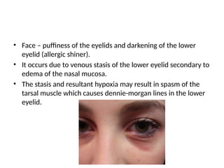 ALLERGIC RHINITIS AND VASOMOTOR RHINITIS.pptx