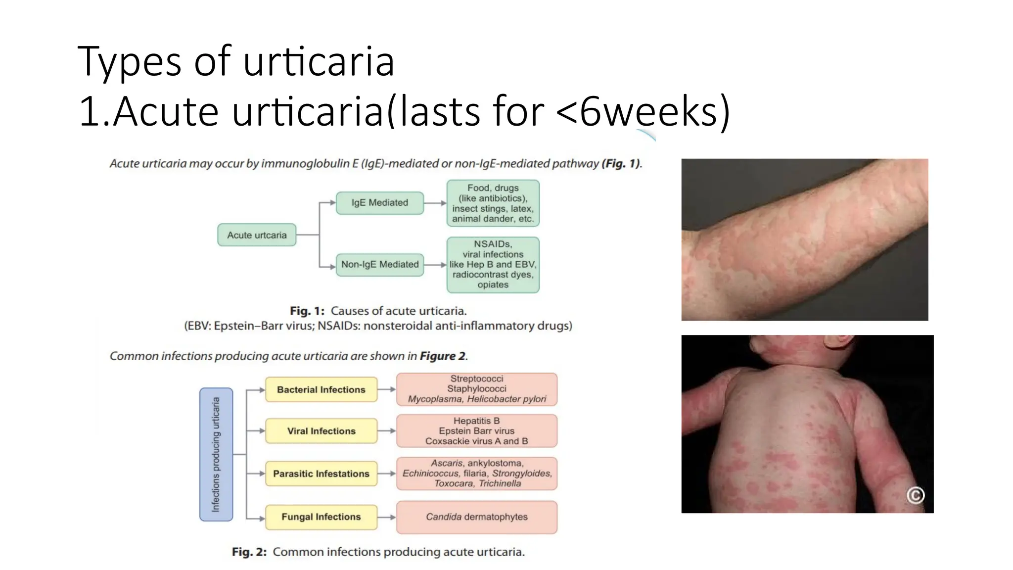 Allergic rhinitis ,Atopic dermatitis, urticaris | PPTX