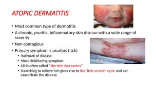 Allergic rhinitis ,Atopic dermatitis, urticaris | PPTX
