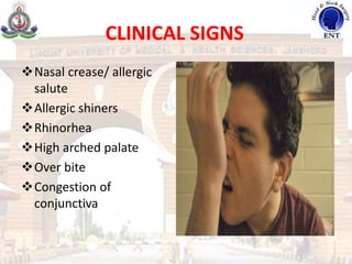 Allergic Rhinitis by Qazi Akhtar .pptx