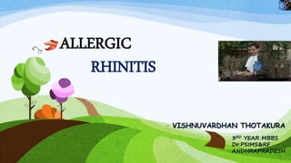Allergic rhinitis ppt 2018 | PPTX