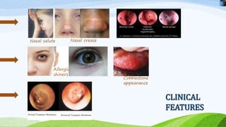 Allergic rhinitis ppt 2018 | PPTX