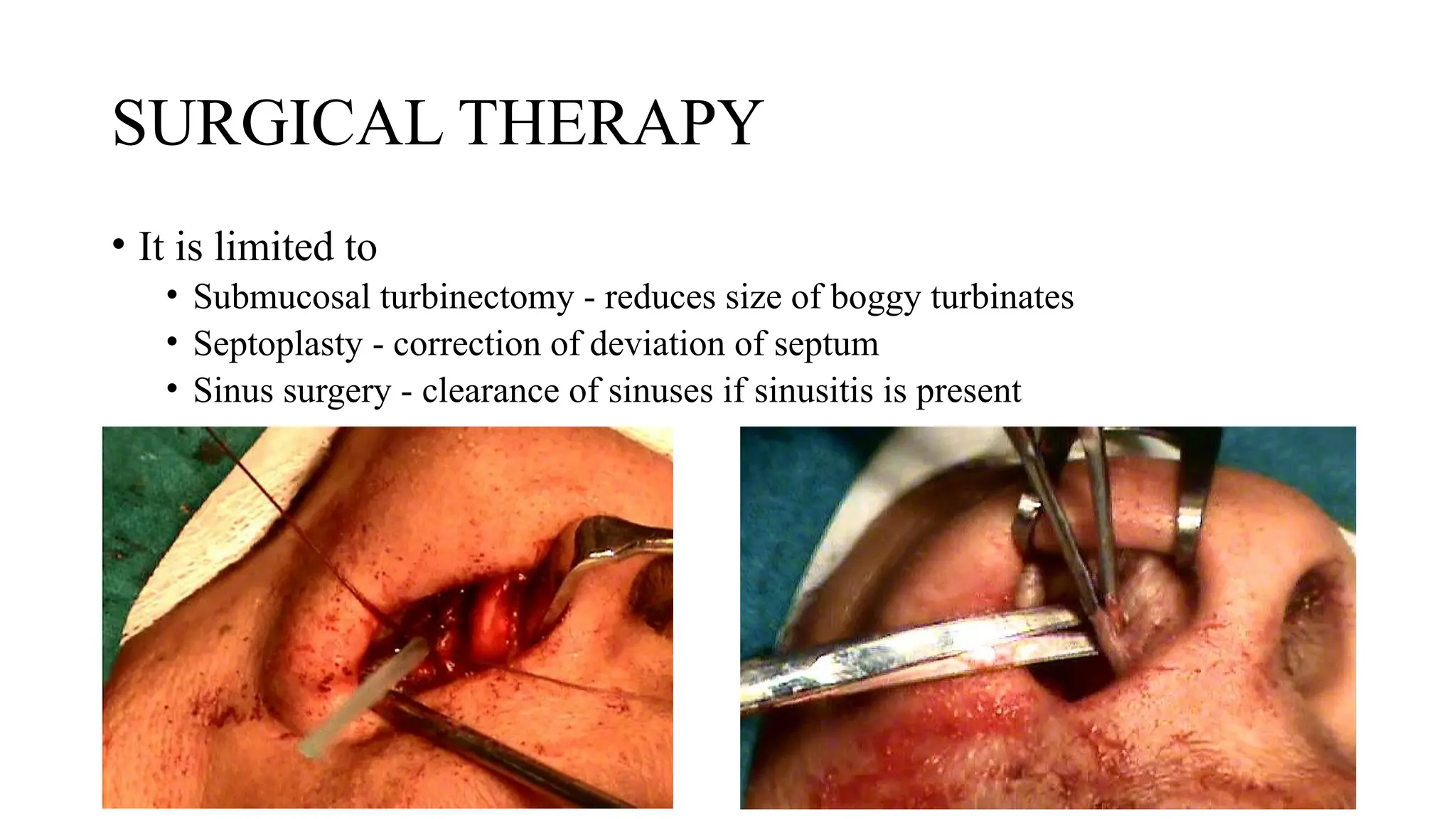 Powerpoint Presentation On Allergic Rhinitiss Pptx