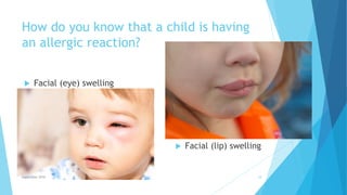 Allergy Anaphylaxis.pptx