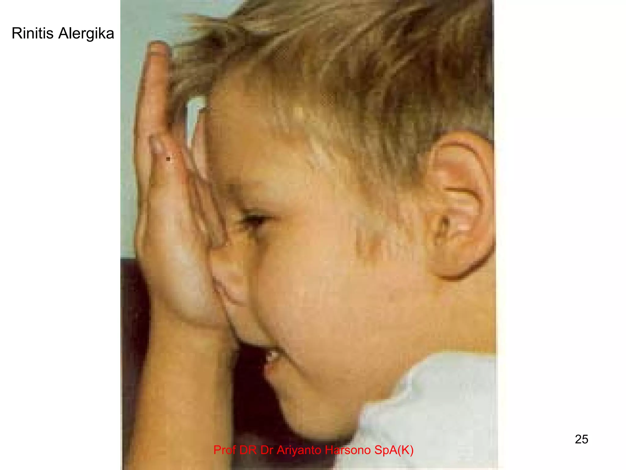 Allergy march from atopic dermatitis to lifelong allergy | PPT