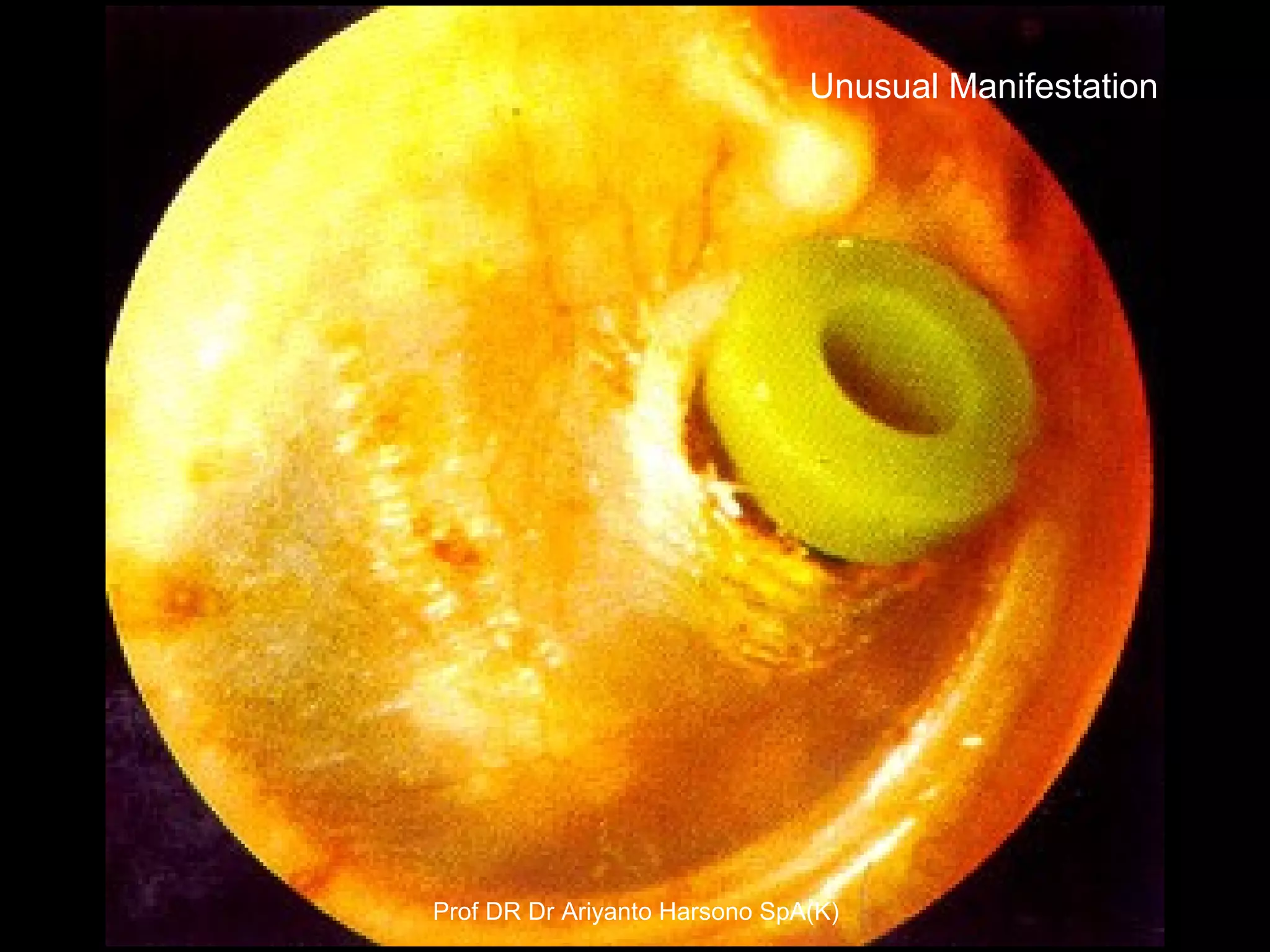 Allergy march from atopic dermatitis to lifelong allergy | PPT