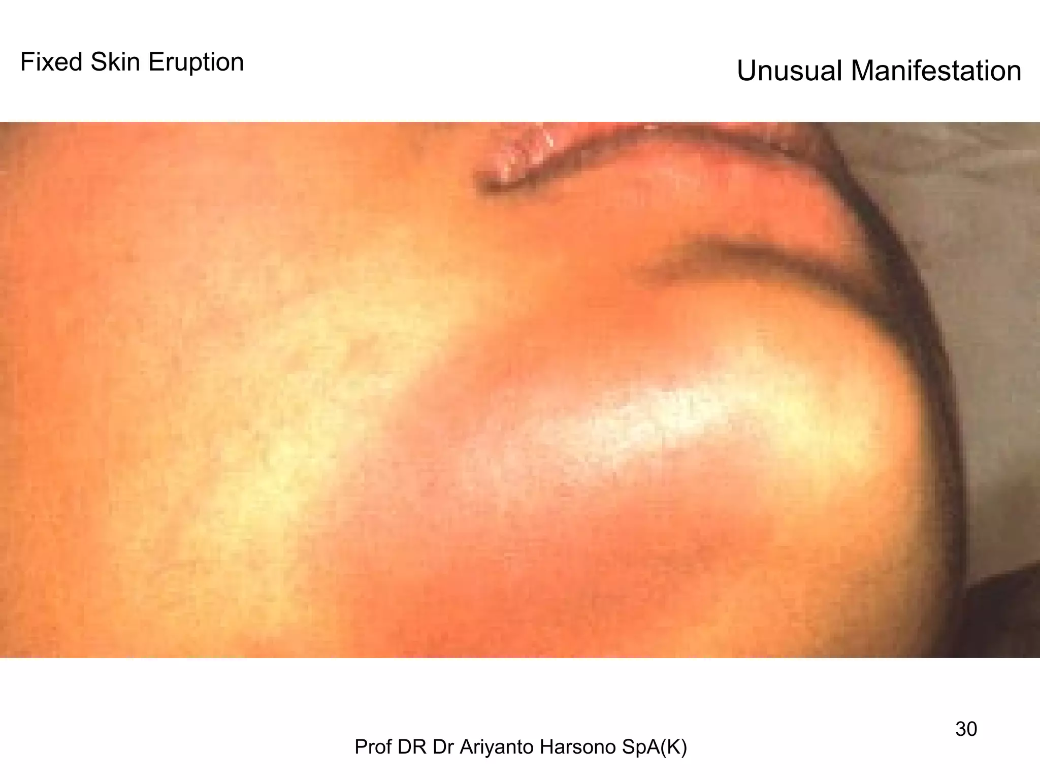 Allergy march from atopic dermatitis to lifelong allergy | PPT