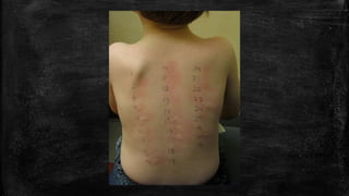 Allergy skin test | PPTX