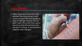 Allergy skin test | PPTX