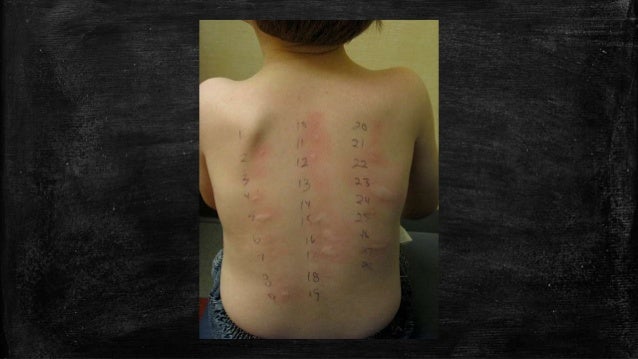 Allergy skin test