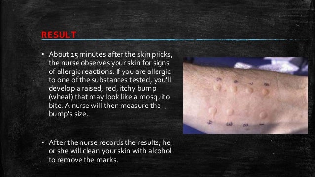 Allergy skin test