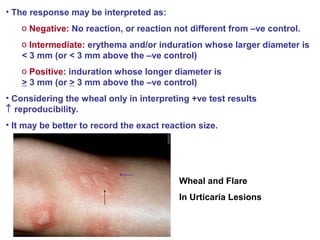 Allergy testing | PPT