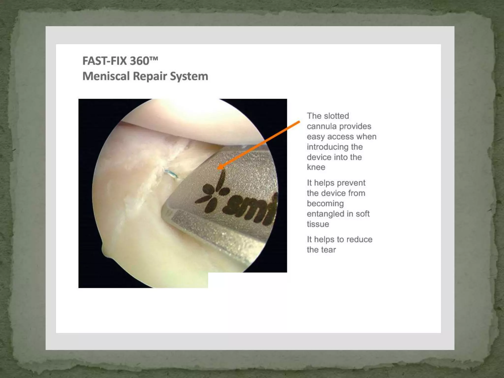Meniscus repair : basics & surgery | PPTX