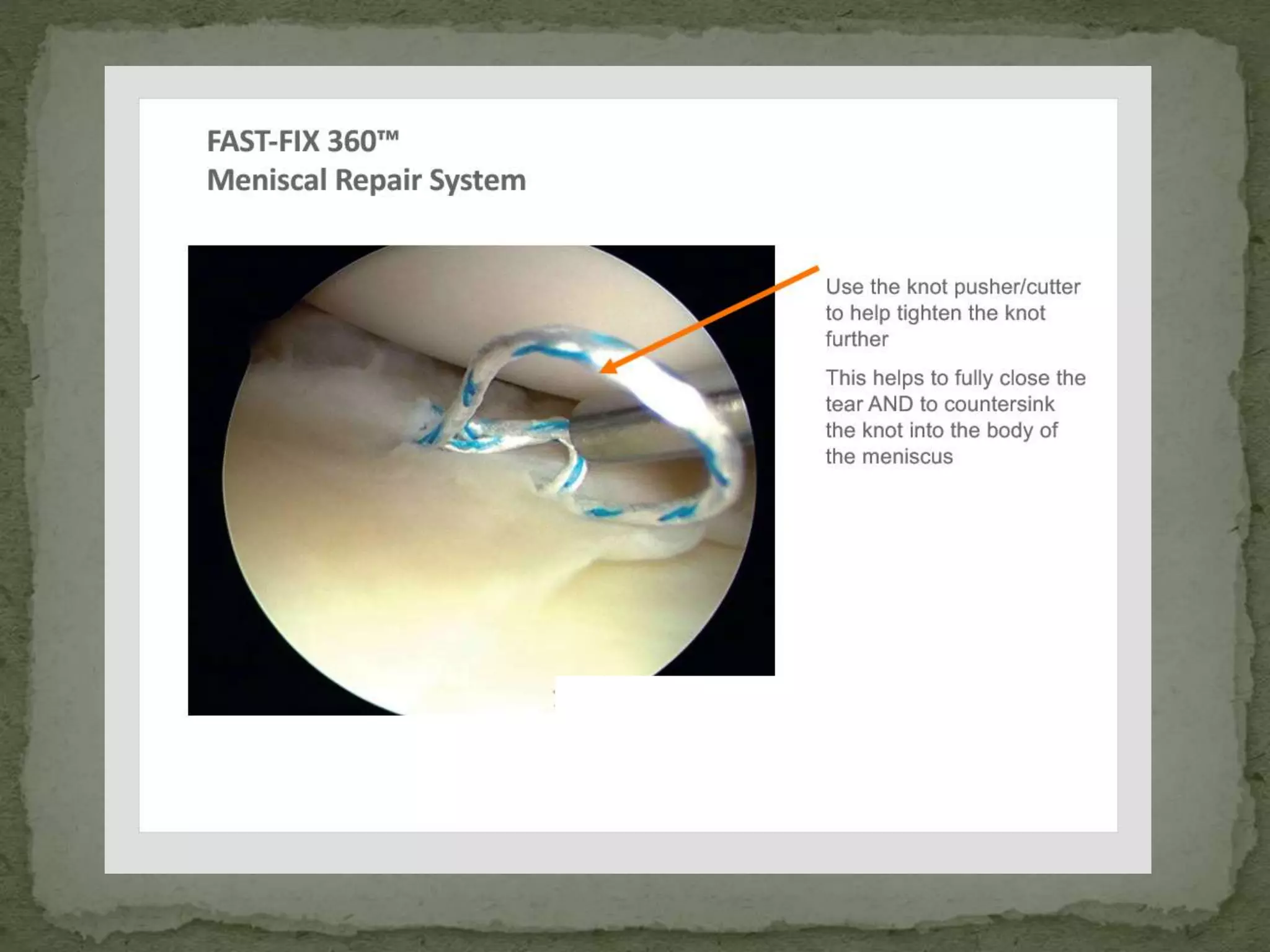 Meniscus repair : basics & surgery | PPTX