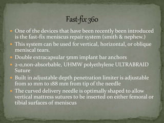 Meniscus repair : basics & surgery | PPTX