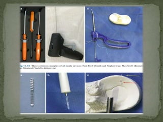 Meniscus repair : basics & surgery | PPTX