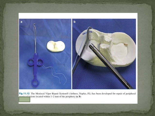 Meniscus repair : basics & surgery | PPTX