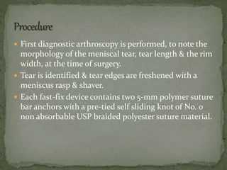 Meniscus repair : basics & surgery | PPTX