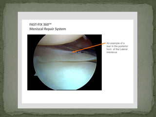 Meniscus repair : basics & surgery | PPTX