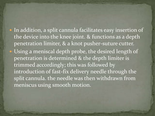 Meniscus repair : basics & surgery | PPTX