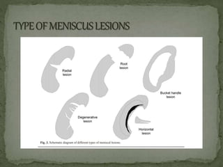 Meniscus repair : basics & surgery | PPTX