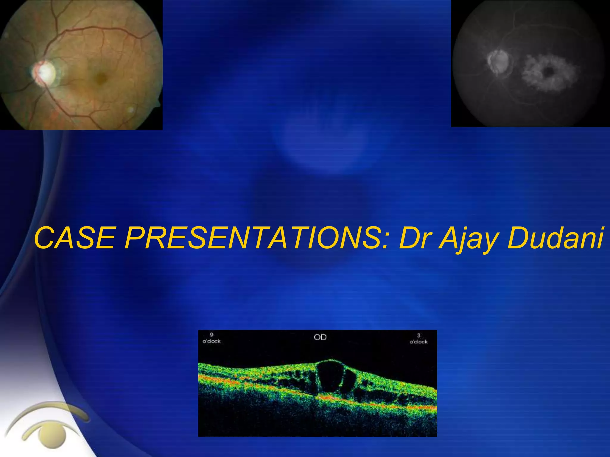 RETINAL CASES-AJAY DUDANI | PPTX