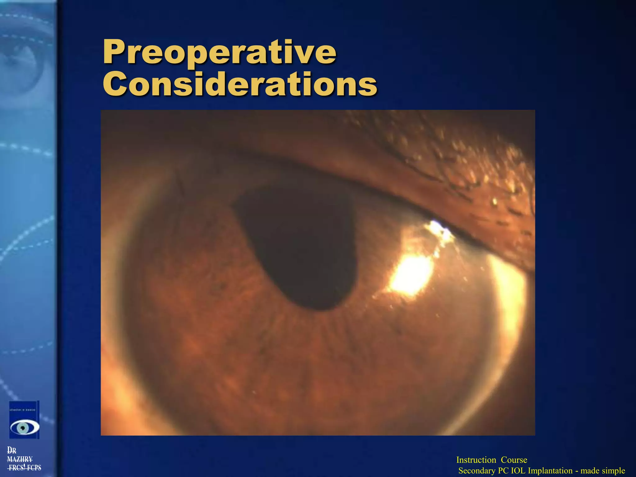 Instruction course-Secondary posterior chamber IOL (PC IOL ...