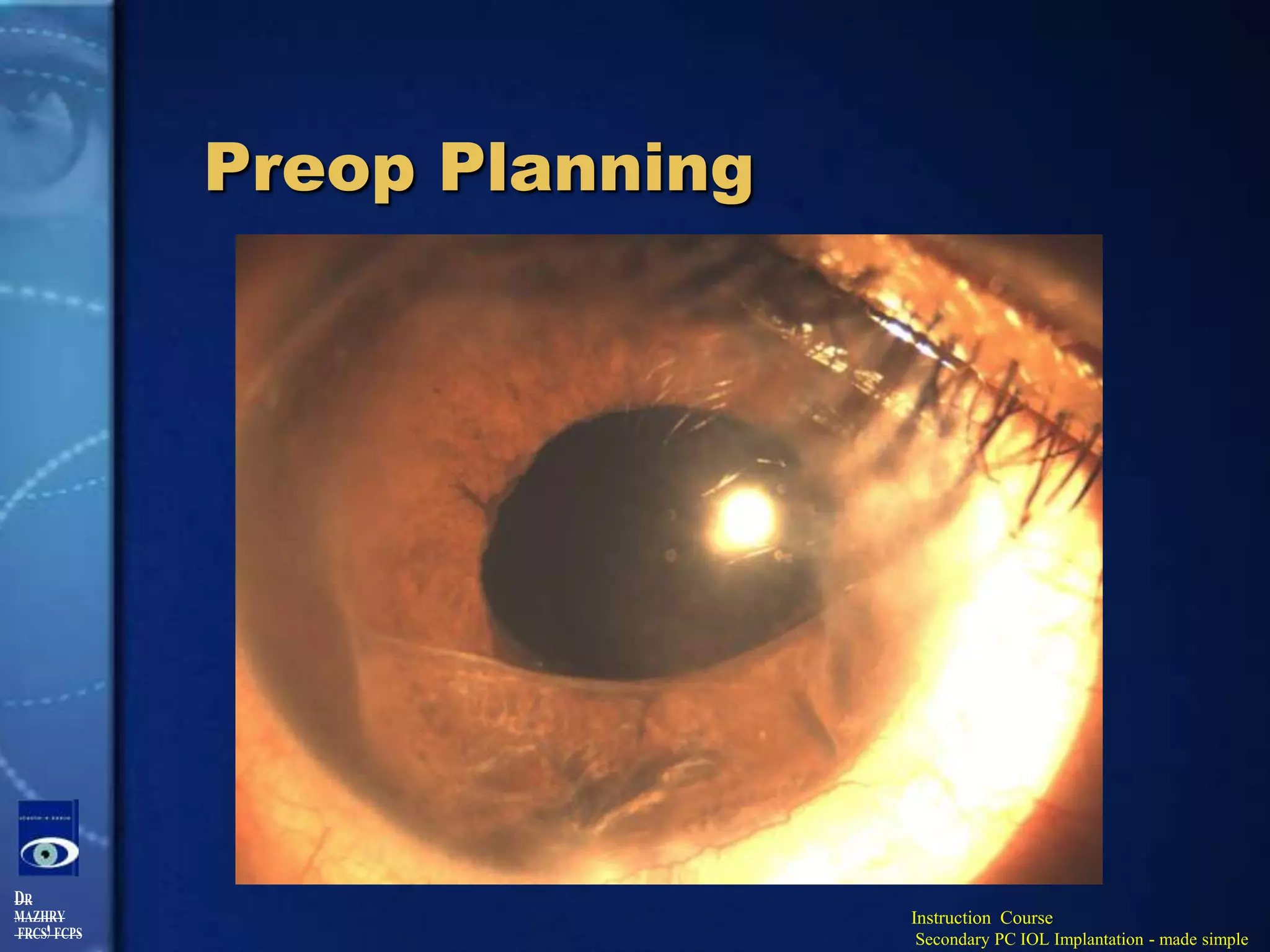 Instruction course-Secondary posterior chamber IOL (PC IOL ...