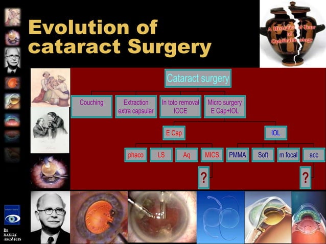Instruction course-Secondary posterior chamber IOL (PC IOL ...