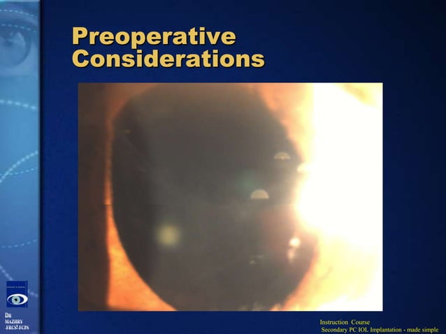 Instruction course-Secondary posterior chamber IOL (PC IOL ...