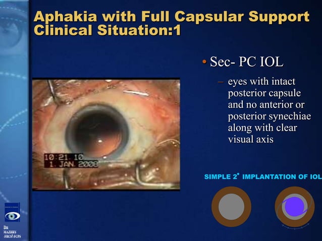Instruction course-Secondary posterior chamber IOL (PC IOL ...