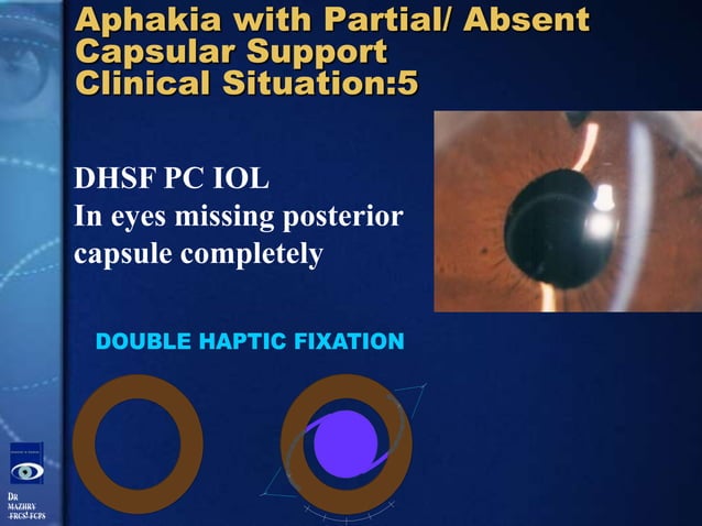 Instruction course-Secondary posterior chamber IOL (PC IOL ...
