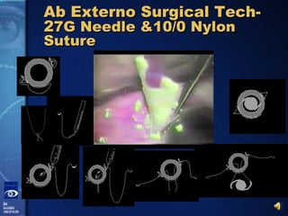 Instruction course-Secondary posterior chamber IOL (PC IOL ...