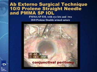Instruction course-Secondary posterior chamber IOL (PC IOL ...