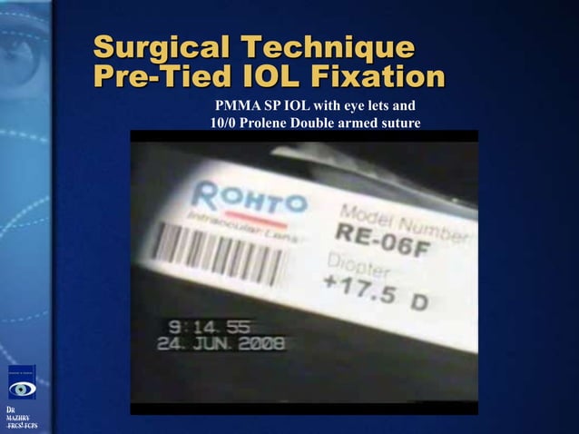 Instruction course-Secondary posterior chamber IOL (PC IOL ...