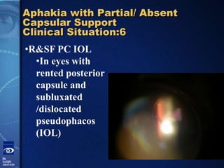 Instruction course-Secondary posterior chamber IOL (PC IOL ...