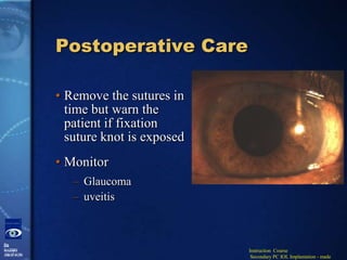Instruction course-Secondary posterior chamber IOL (PC IOL ...