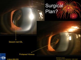 Instruction course-Secondary posterior chamber IOL (PC IOL ...