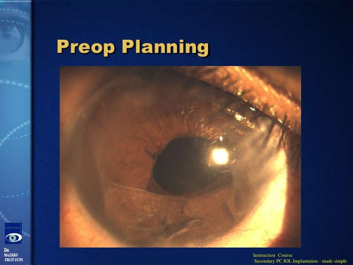 Instruction course-Secondary posterior chamber IOL (PC IOL) Implantat…