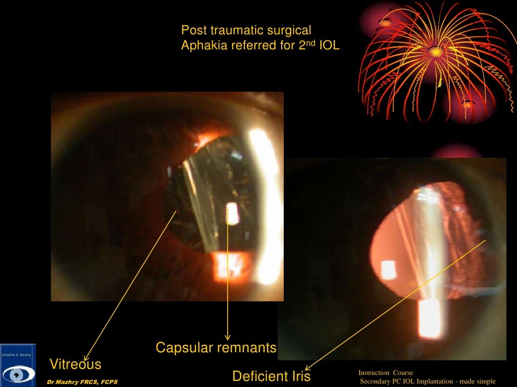 Instruction course-Secondary posterior chamber IOL (PC IOL) Implantat…