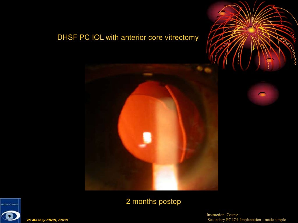 Instruction course-Secondary posterior chamber IOL (PC IOL) Implantat…