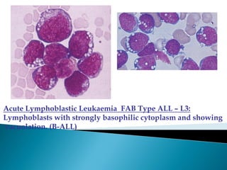 ALL_Naseem. Acute Lymphoblastic leukemia presentation PPTpdf | PDF