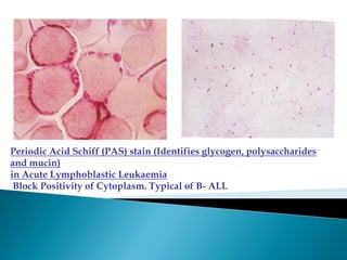 ALL_Naseem. Acute Lymphoblastic leukemia presentation PPTpdf | PDF