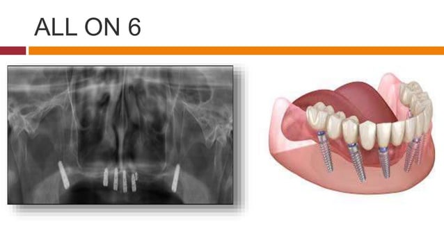 All on 4 and all on 6 | PPTX | Dental Health | Diseases and Conditions
