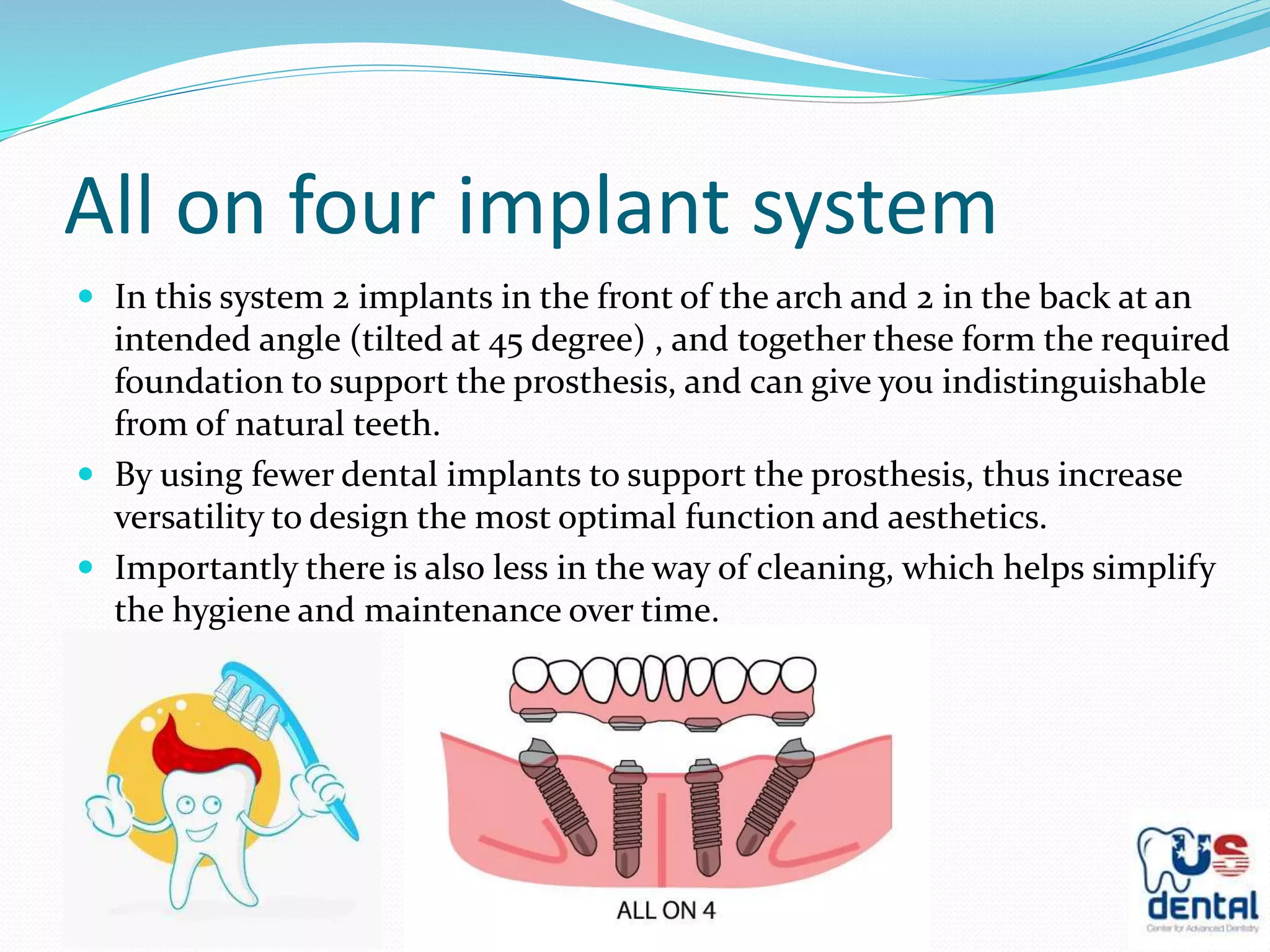 All On Four Dental Implant System | PPTX