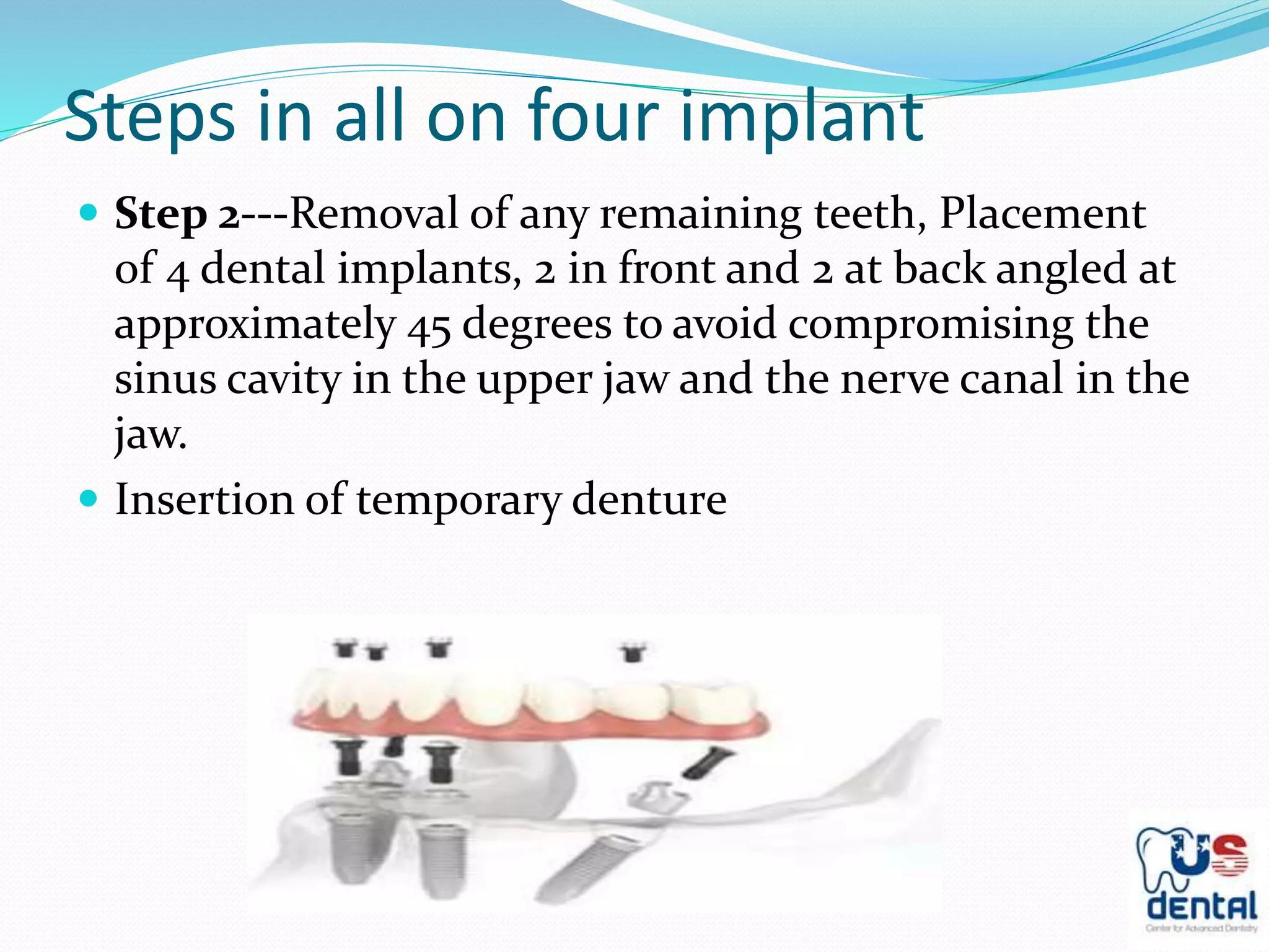 All On Four Dental Implant System | PPTX