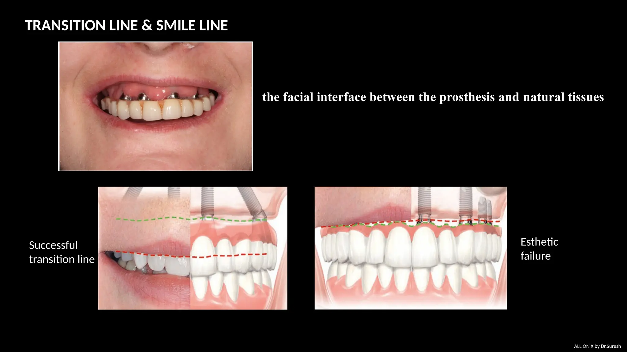 ALL On X / All on 4 /All on 6 Concepts.pptx