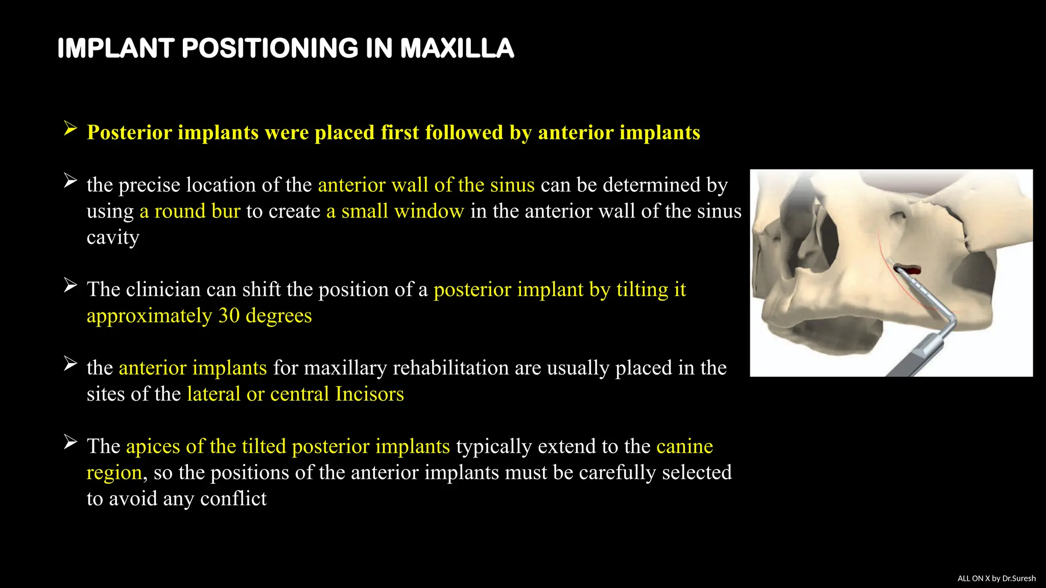 ALL On X / All on 4 /All on 6 Concepts.pptx