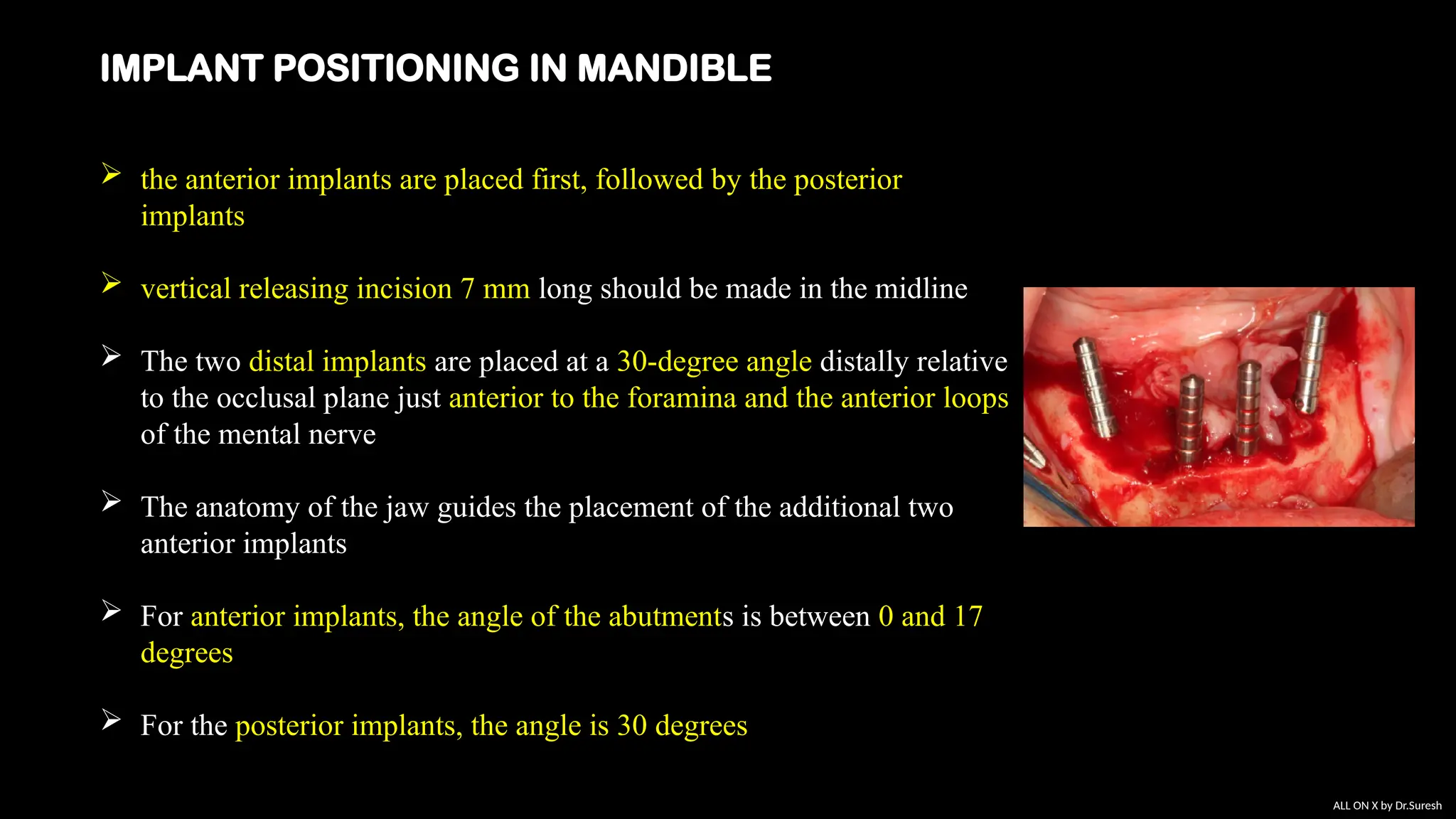 ALL On X / All on 4 /All on 6 Concepts.pptx