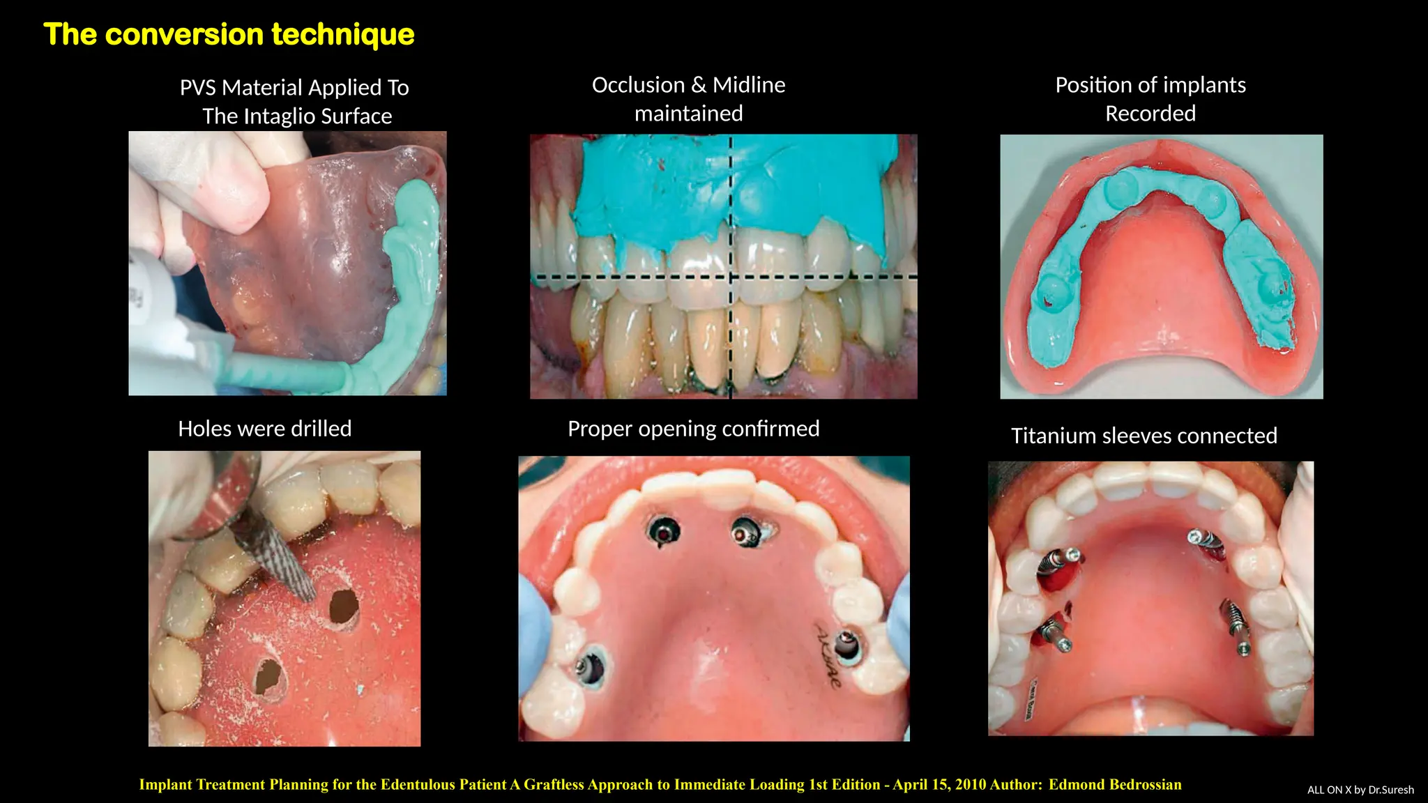 ALL On X / All on 4 /All on 6 Concepts.pptx